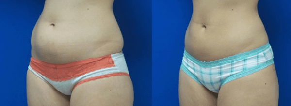 Non Surgical Body Sculpting Options Dr Rudolf Thompson
